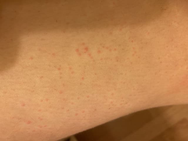 small red bumps on thighs | Skin Concern